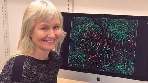 Nya terapier för hjärntumör | Barncancerfonden