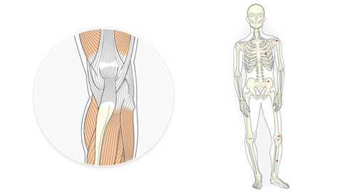 Sarkom I Barncancerfonden | Barncancerfonden