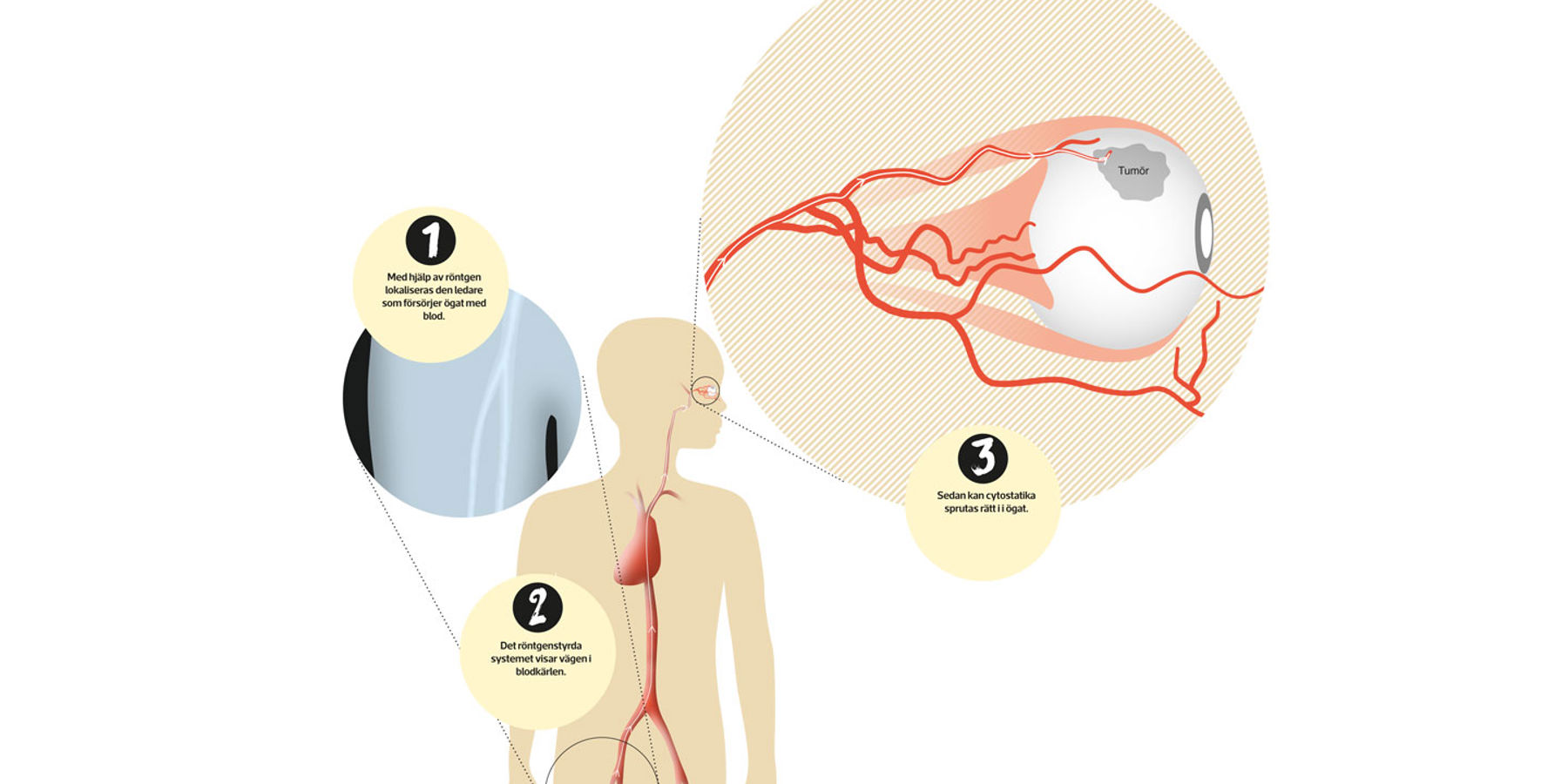 Cytostatika i ljumsken vid cancer i ögat | Barncancerfonden